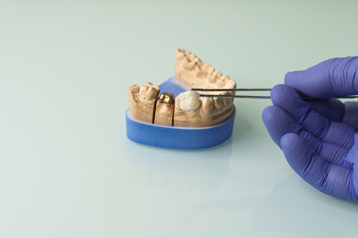 Custom vs Prefabricated Dental Prosthetics - Imagine Dental